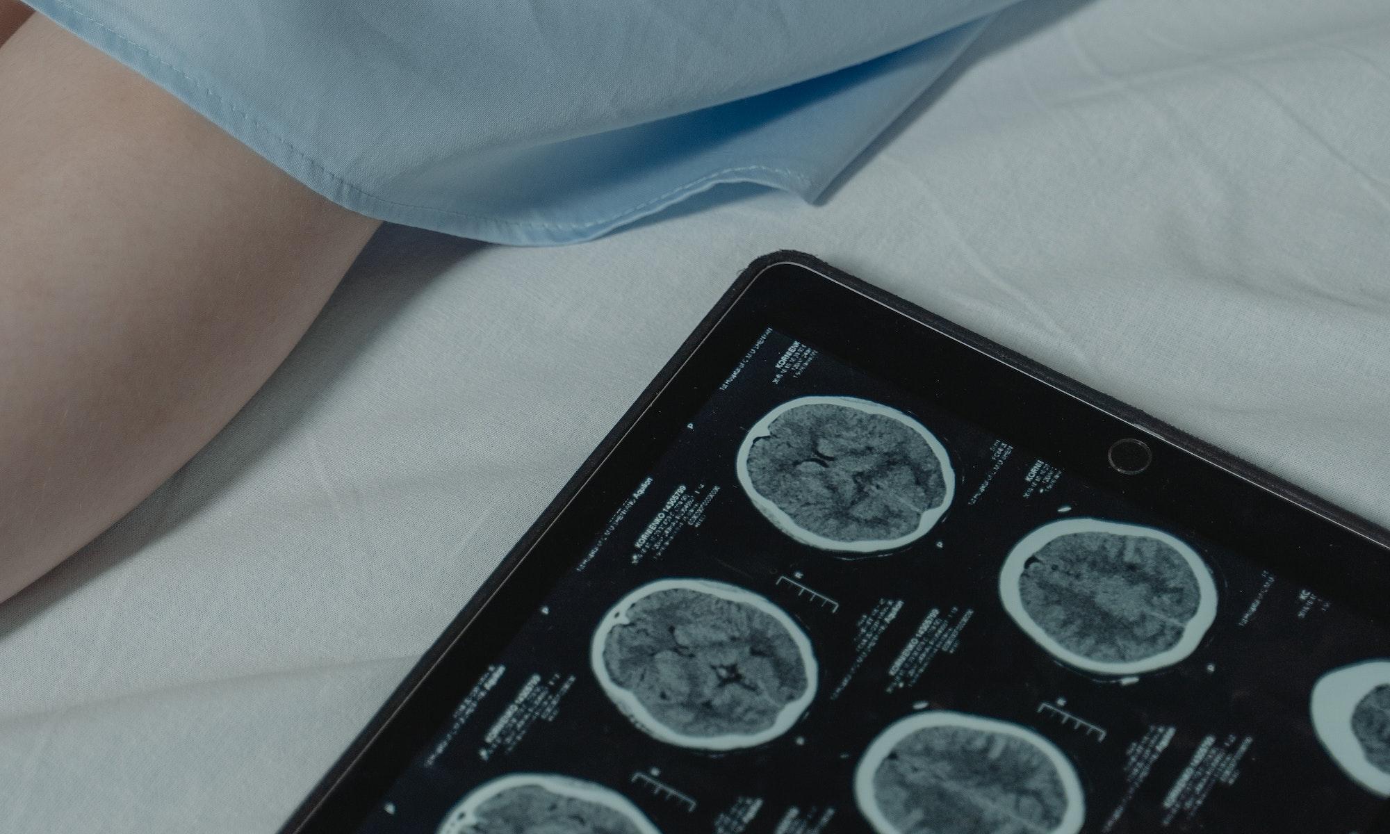 Ataksija | Simptomi i liječenje | Fizioterapija | ALSPHYSIO